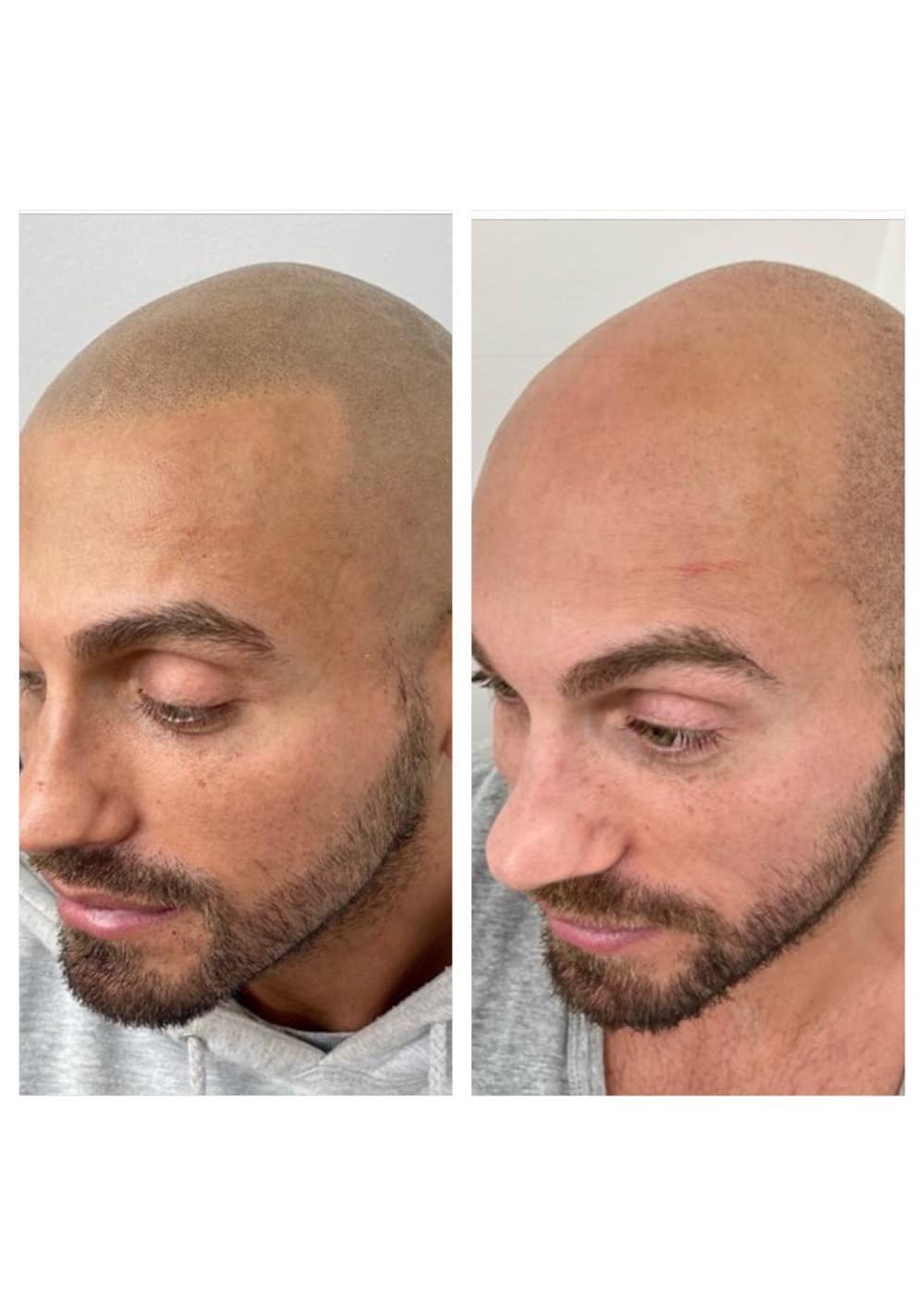 SMP Results Gallery | Natural Scalp | Cardiff & South Wales